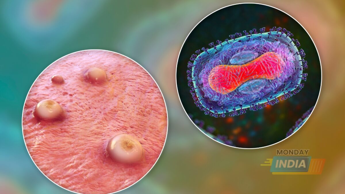 Mpox Crisis: WHO's Global Health Emergency Declaration Explained